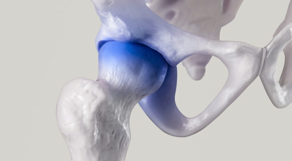 What are the risks associated with hip replacement surgery? - Grosvenor ...